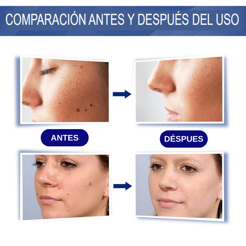 WartRemover - Crema para eliminar Lunares y Verrugas, Ungüento medicin
